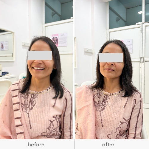 Buy 2" Invisible Push Up Hair Patch Online For Fuller Look