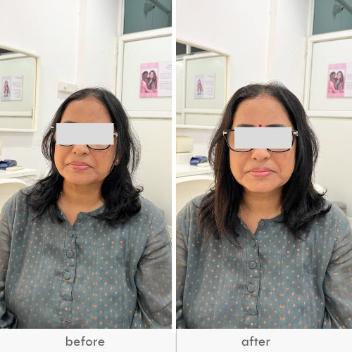 Buy 2" Invisible Push Up Hair Patch Online For Fuller Look